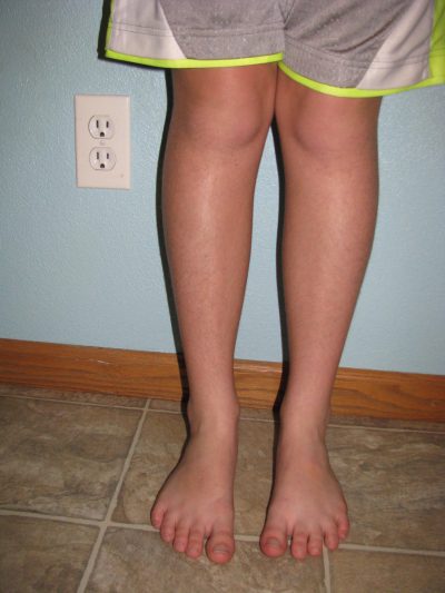 The Strange Case of the Uneven Legs – Michelle Kaderly Welsh